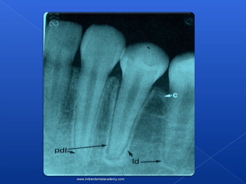 Lamina dura/ oral surgery courses