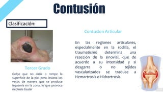 Lesiones traumáticas. Contusión, esguince y luxación | PPTX