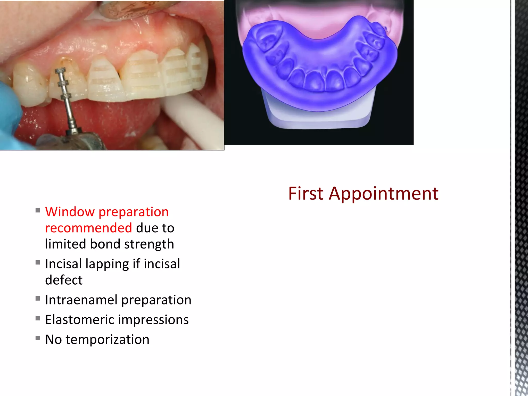 Dental Veneers & Laminates | PPT