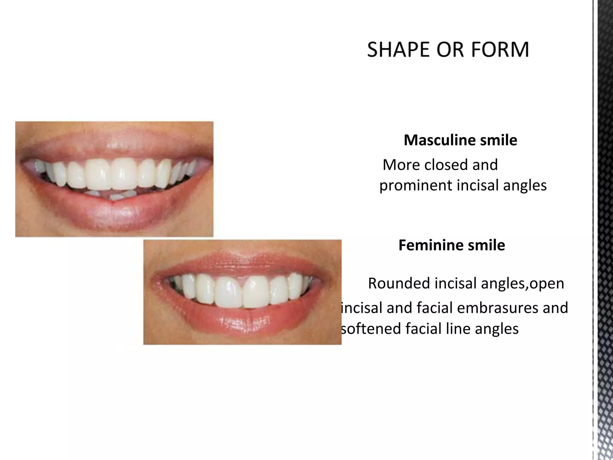 Dental Veneers & Laminates | PPT