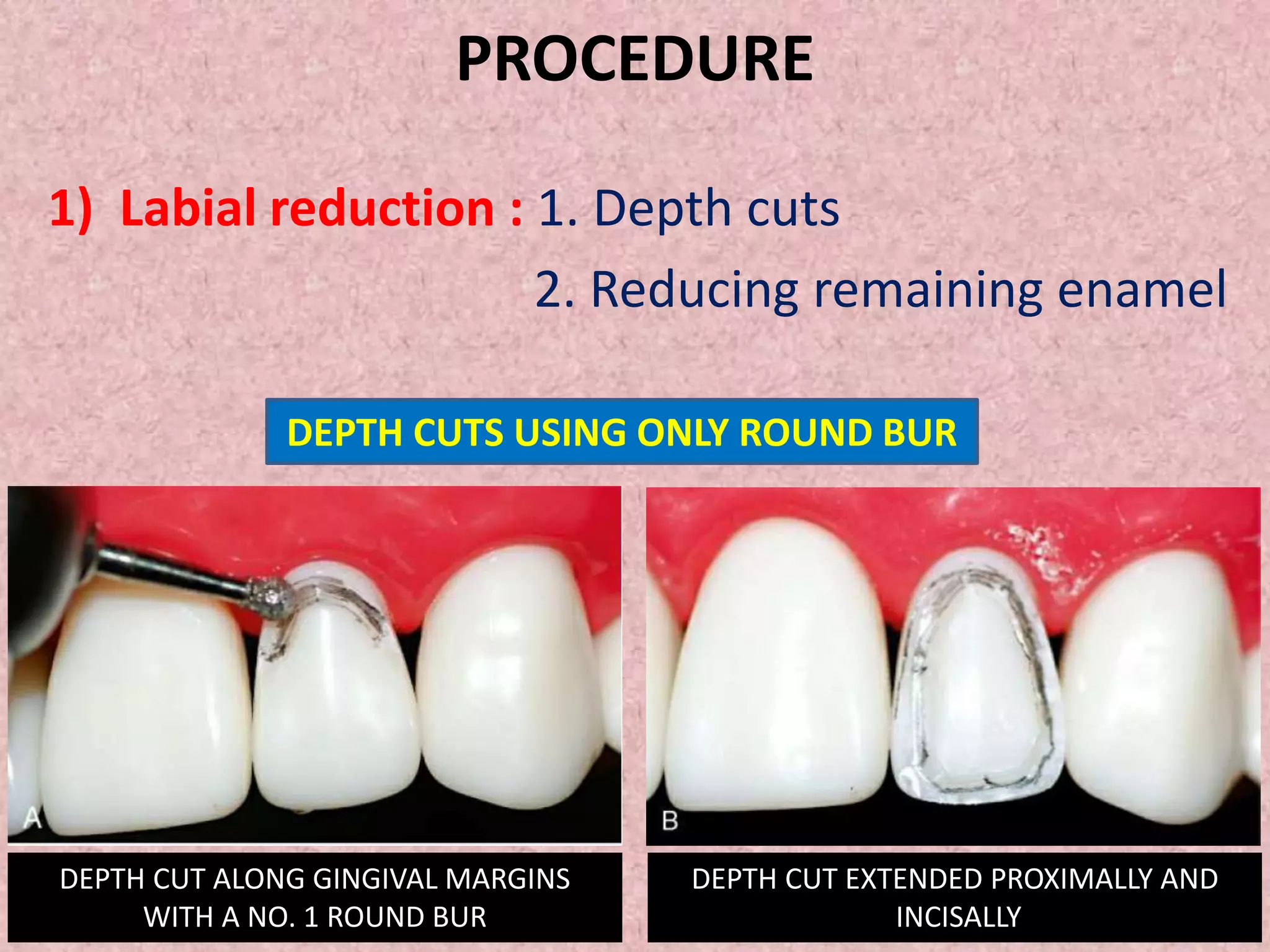LAMINATES VENEERS.pptx