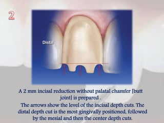 Laminate veneer. | PPTX