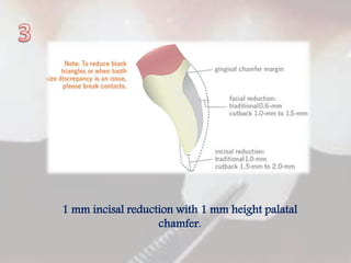 Laminate veneer. | PPTX