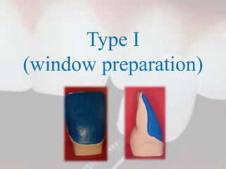 Laminate veneer. | PPTX