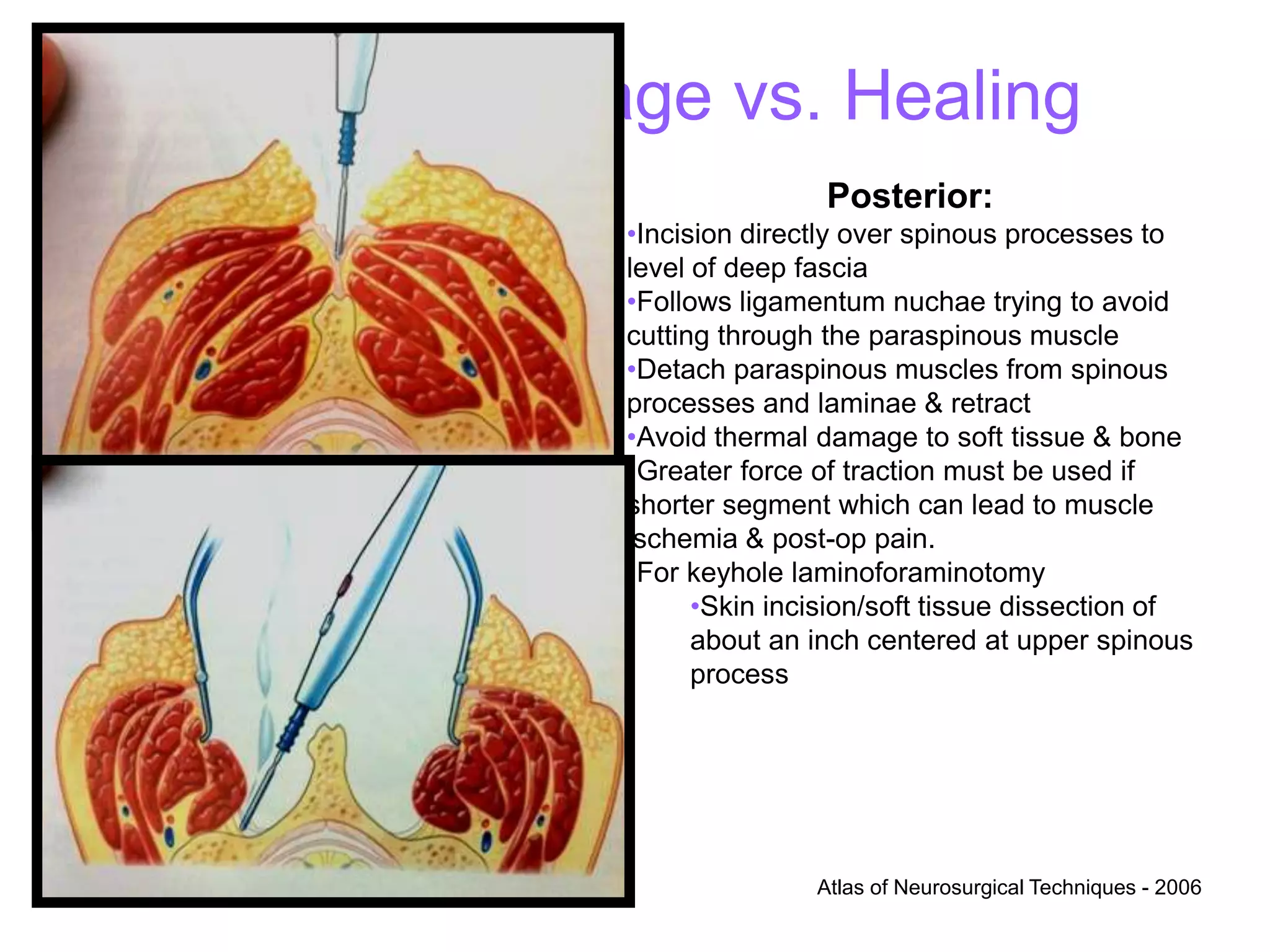 Laminectomy vs Discectomy in Rehabilitation | PPT