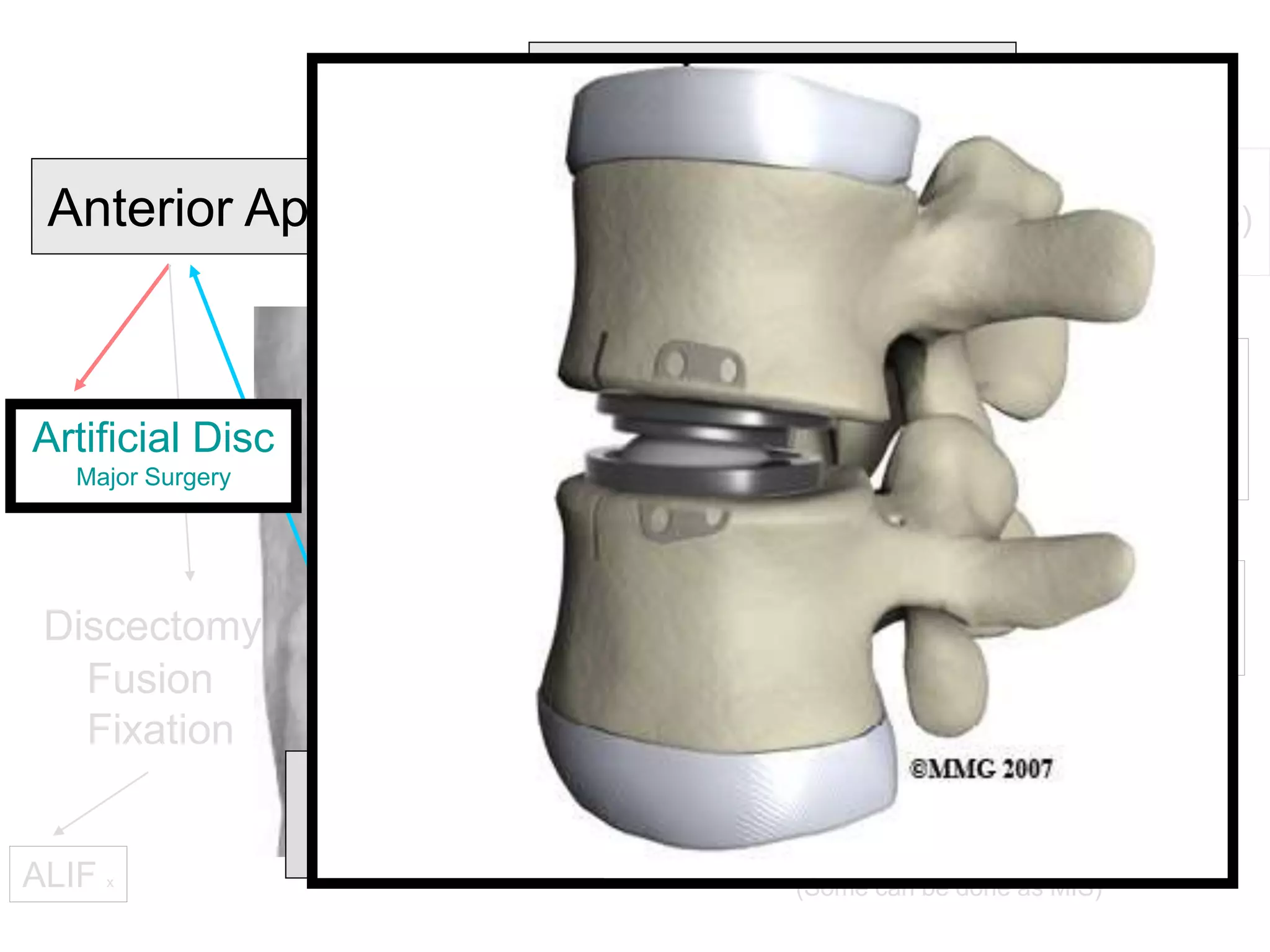 Laminectomy vs Discectomy in Rehabilitation | PPT
