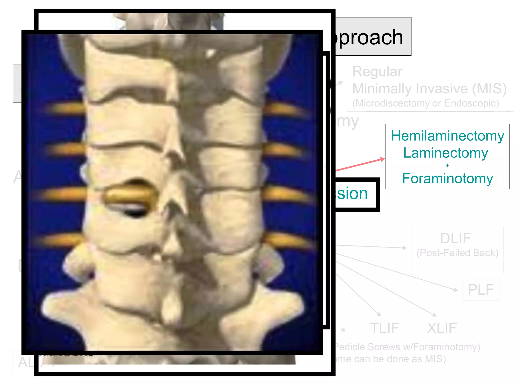 Laminectomy vs Discectomy in Rehabilitation | PPT