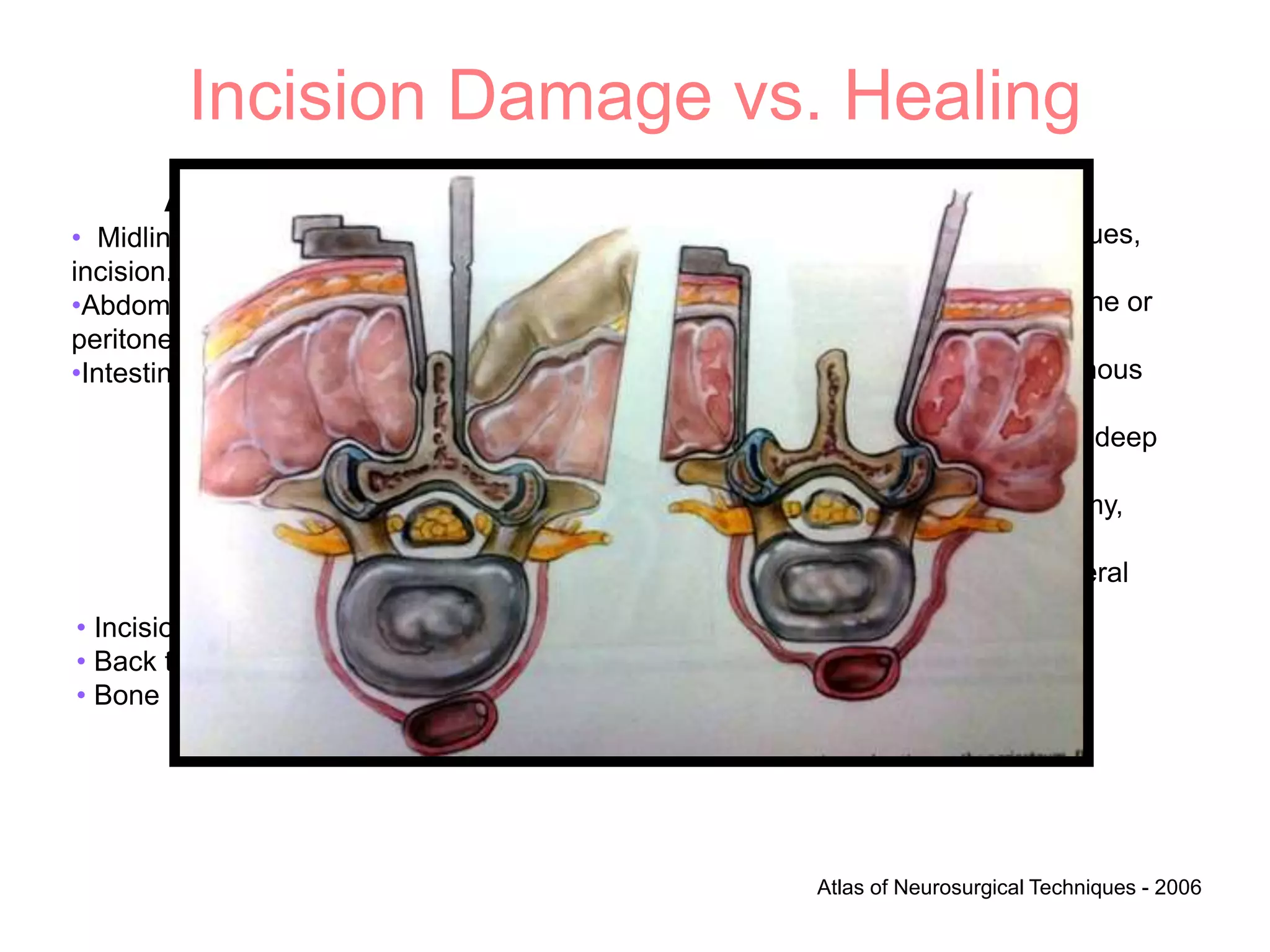Laminectomy vs Discectomy in Rehabilitation | PPT