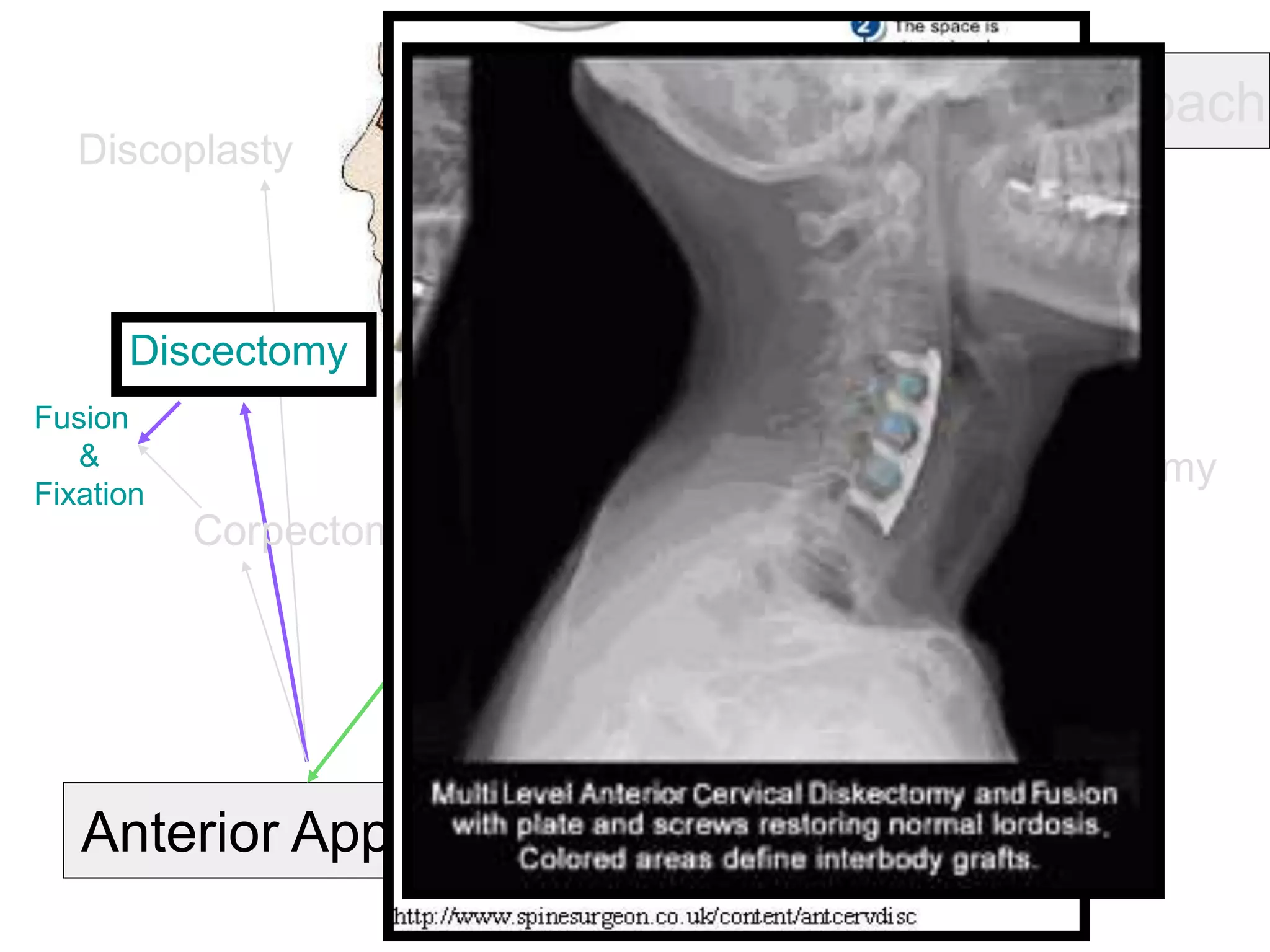 Laminectomy vs Discectomy in Rehabilitation | PPT