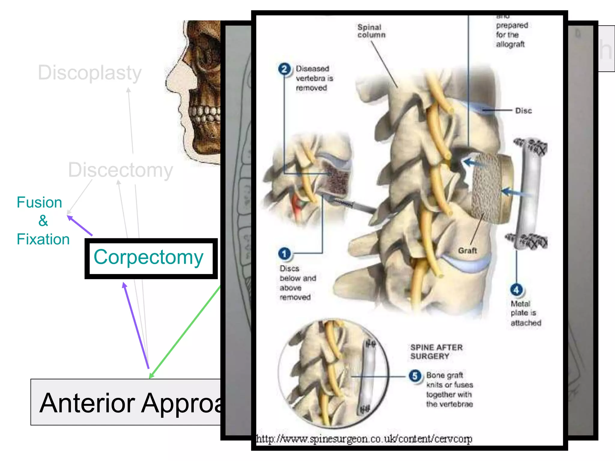 Laminectomy vs Discectomy in Rehabilitation | PPT