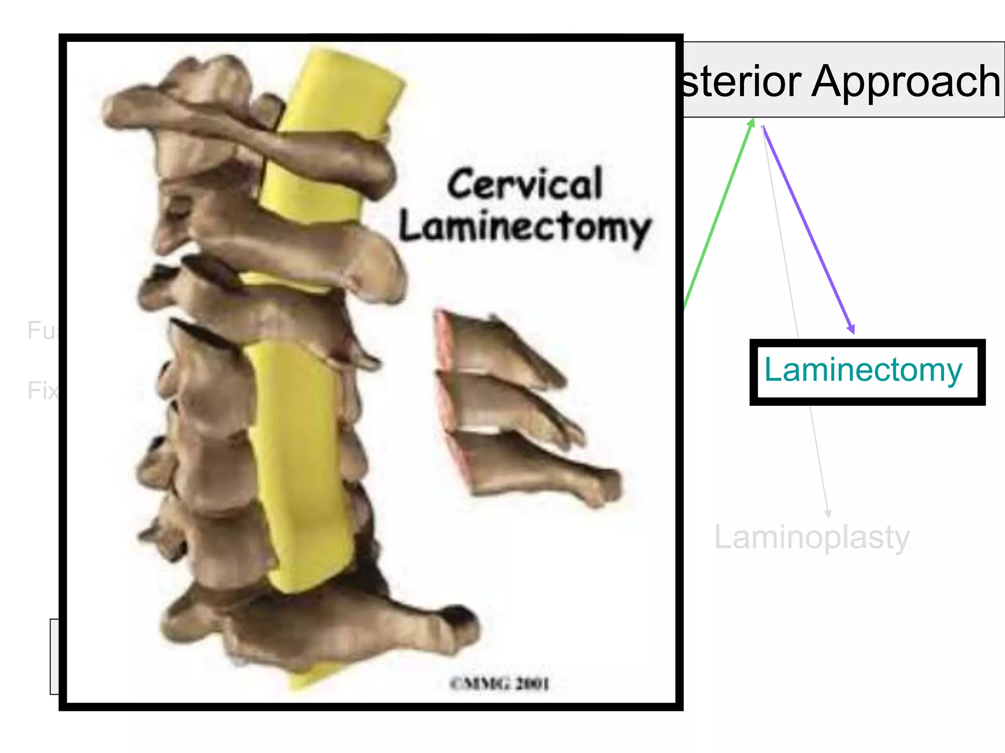 Laminectomy vs Discectomy in Rehabilitation | PPT