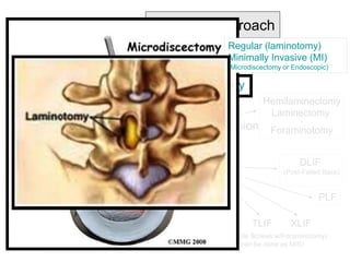 Laminectomy vs Discectomy in Rehabilitation | PPT