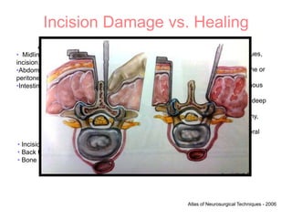 Laminectomy vs Discectomy in Rehabilitation | PPT