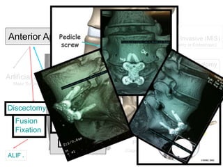 Laminectomy vs Discectomy in Rehabilitation | PPT