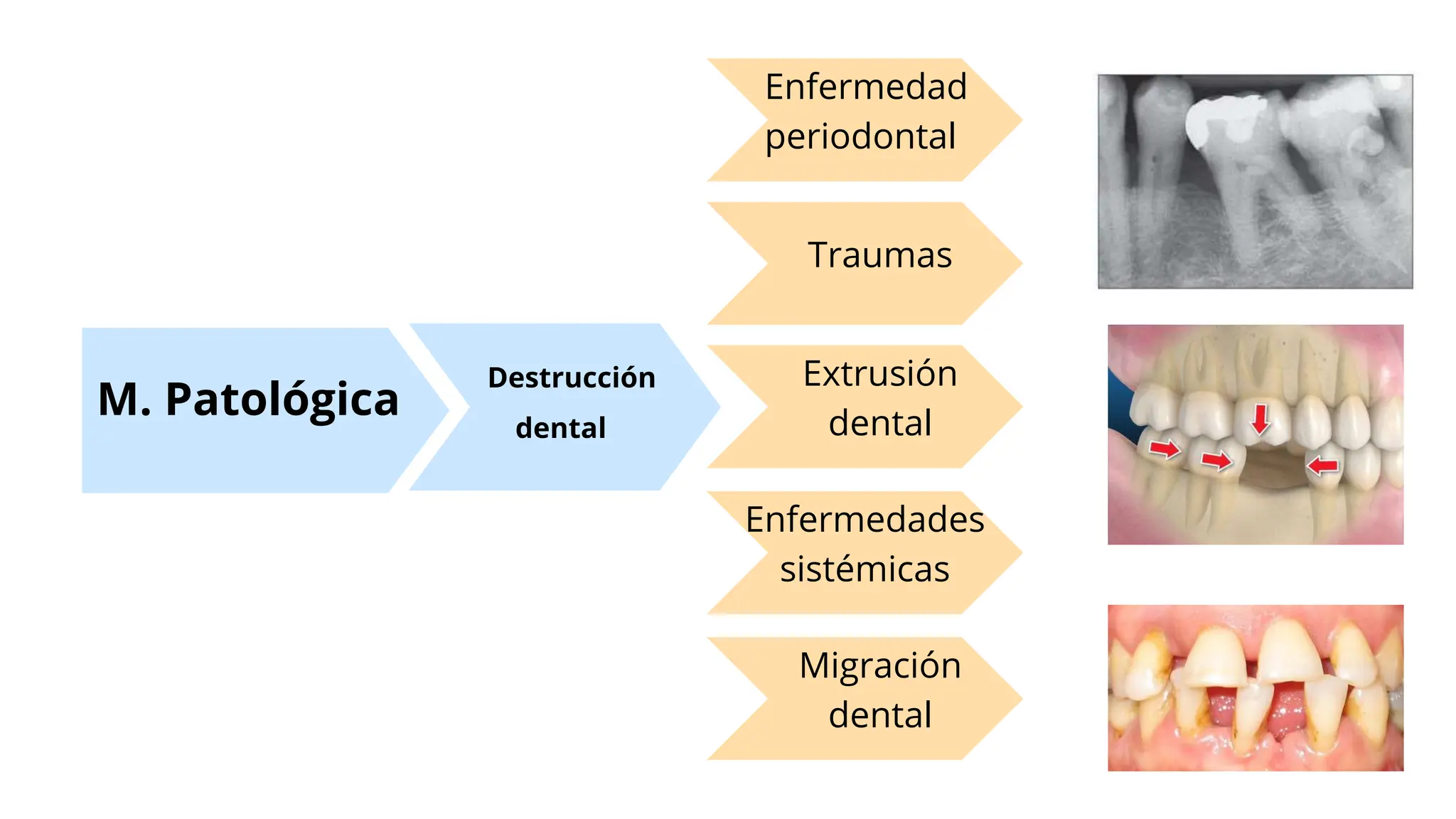 La movilidad dental, en que consiste y tipos | PPTX