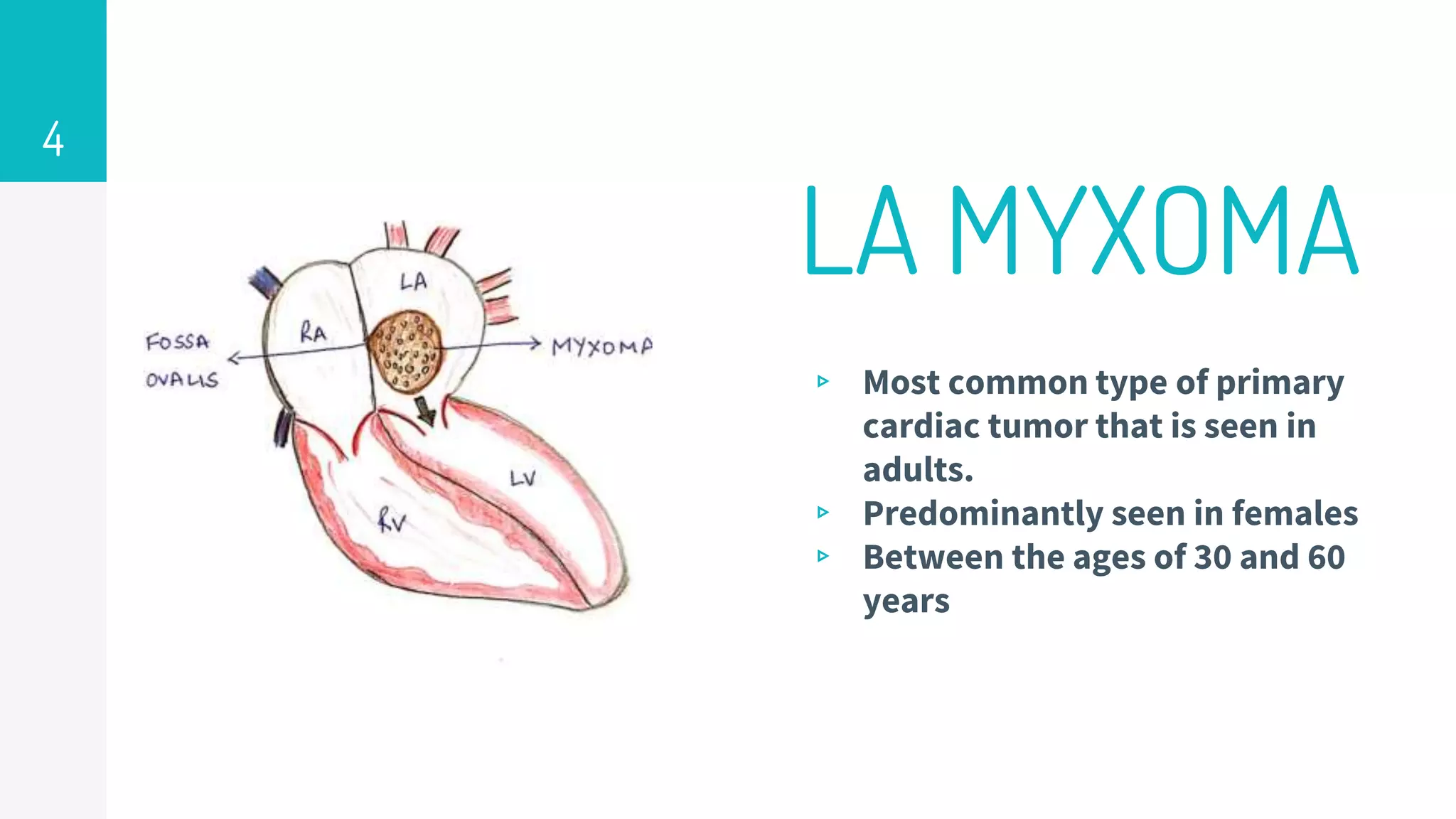 LA Myxoma - For Medical Students | PPTX