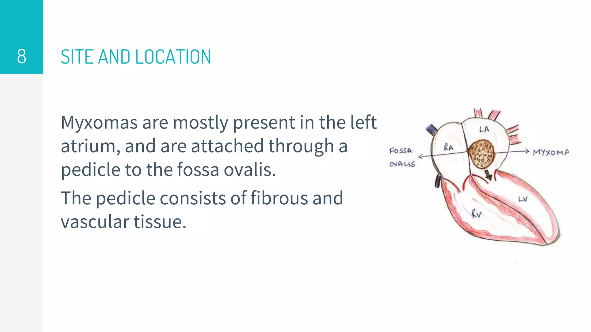 LA Myxoma - For Medical Students | PPTX