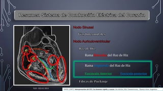 HEMIBLOQUEOS: Criterios Electrocardiográficos para su diagnóstico y ...
