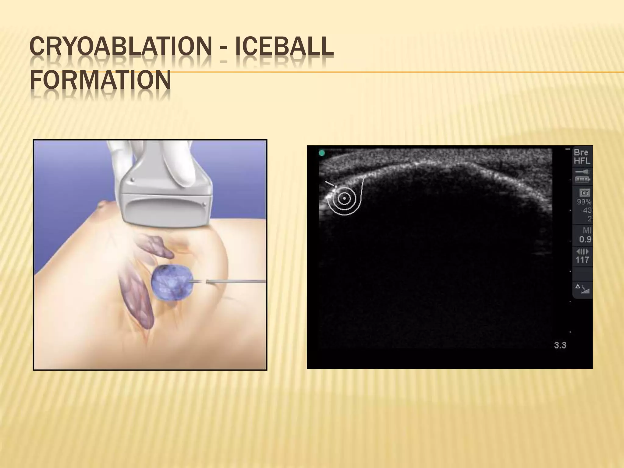 Landmark trials in breast Cancer surgery - NSABP 04,06,MILAN,EORTC ...