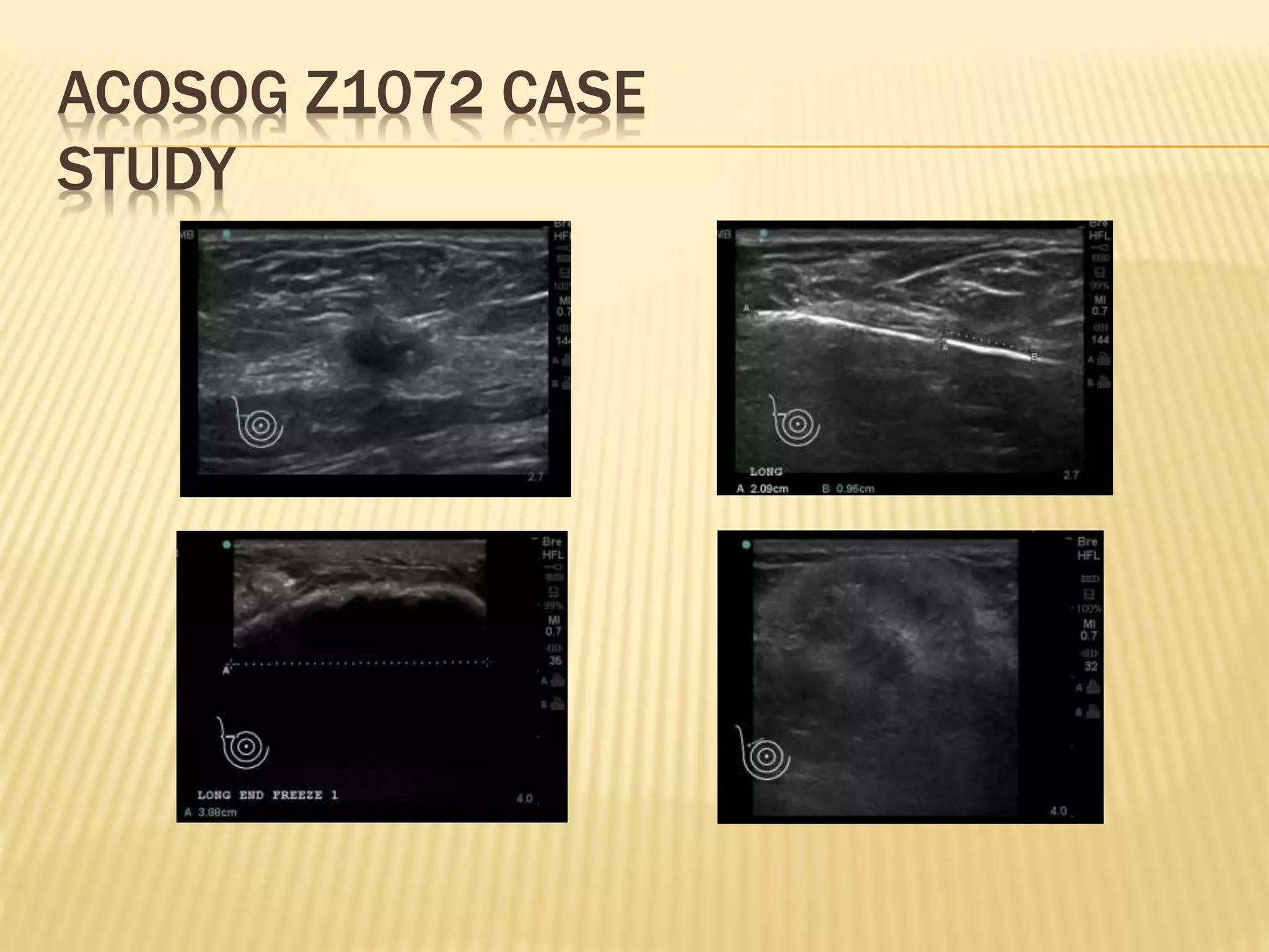 Landmark trials in breast Cancer surgery - NSABP 04,06,MILAN,EORTC ...