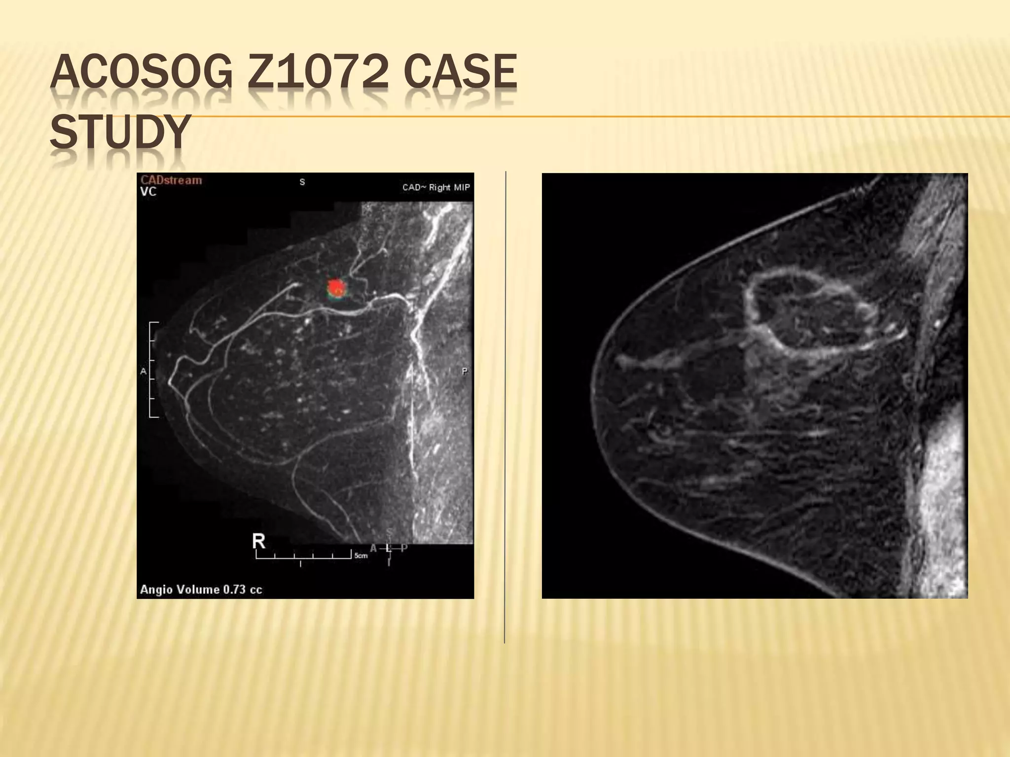 Landmark trials in breast Cancer surgery - NSABP 04,06,MILAN,EORTC ...
