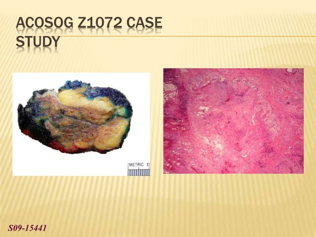 Landmark trials in breast Cancer surgery - NSABP 04,06,MILAN,EORTC ...
