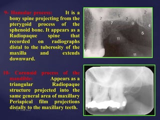 Hamular Process Radiography