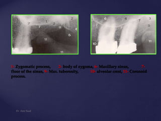 Zygomatic Tuberosity