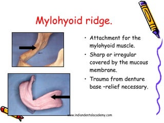 Mylohyoid Ridge Denture