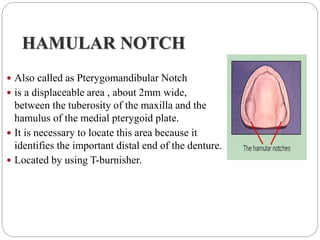 Hamular Notch