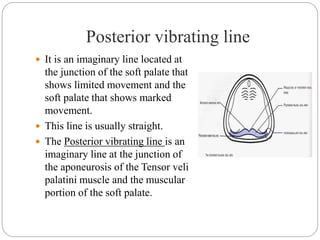 Fovea Palatini Vibrating Line