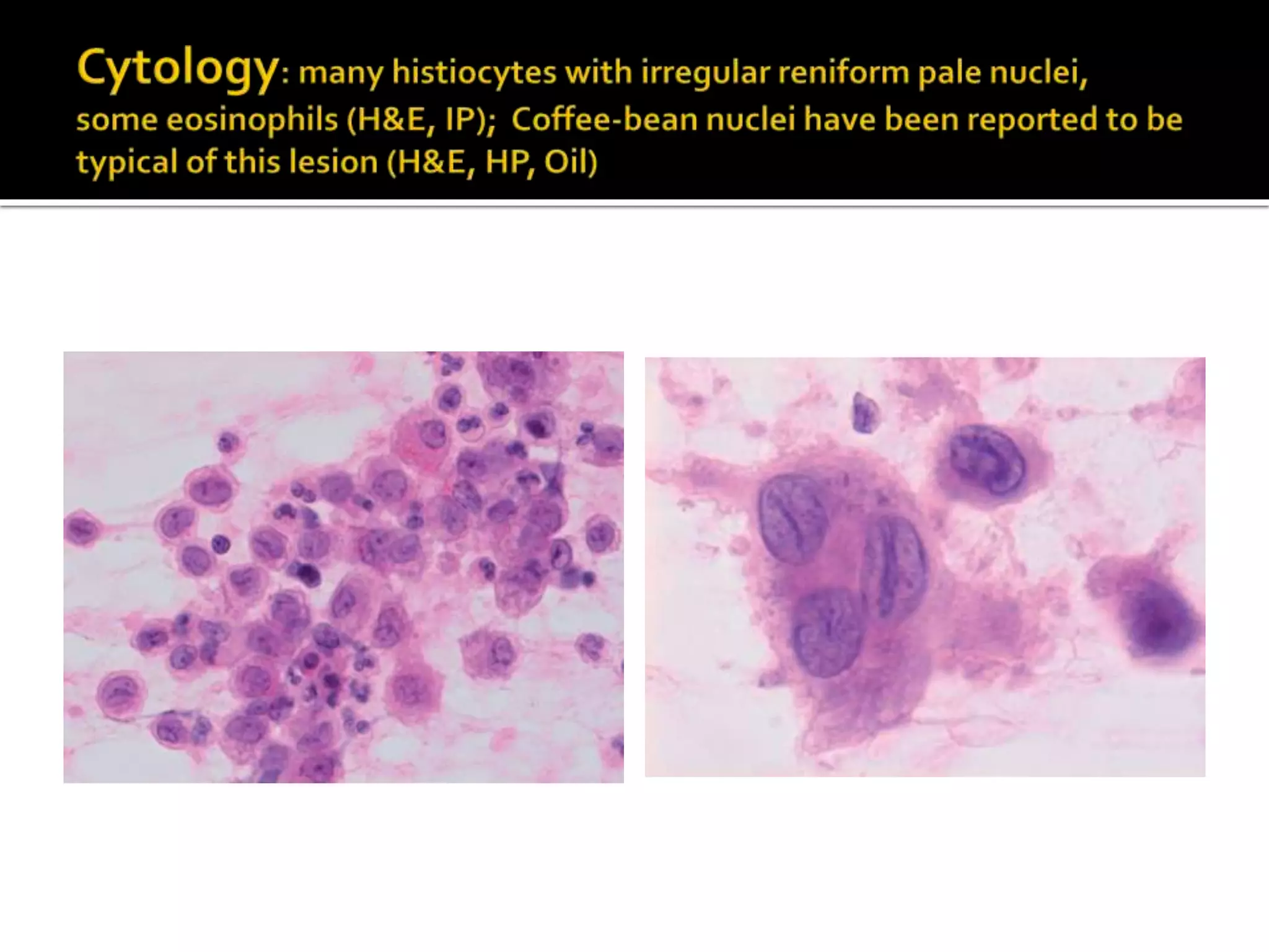 Langerhans cell histiocytosis | PPTX