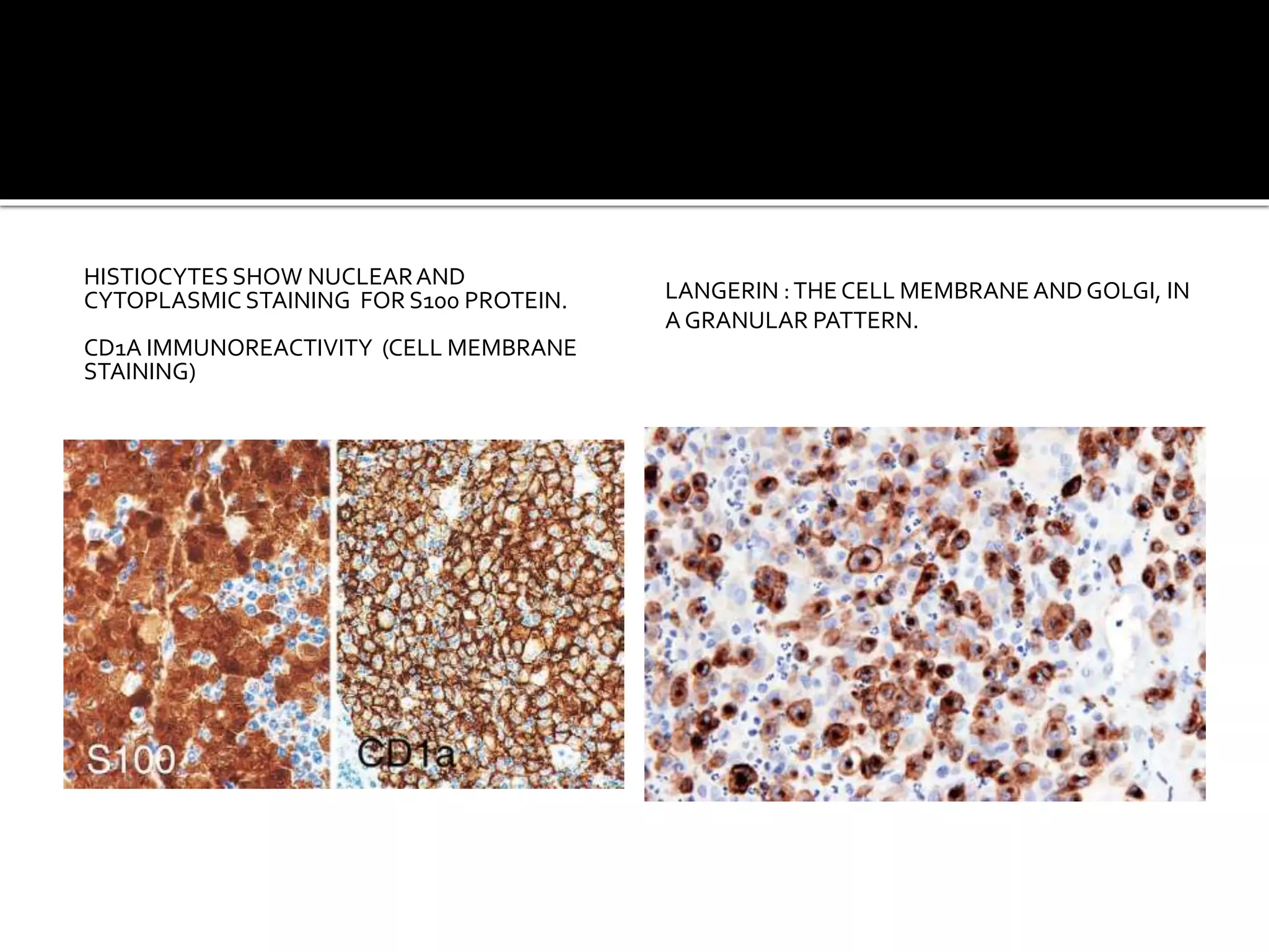 Langerhans cell histiocytosis | PPTX