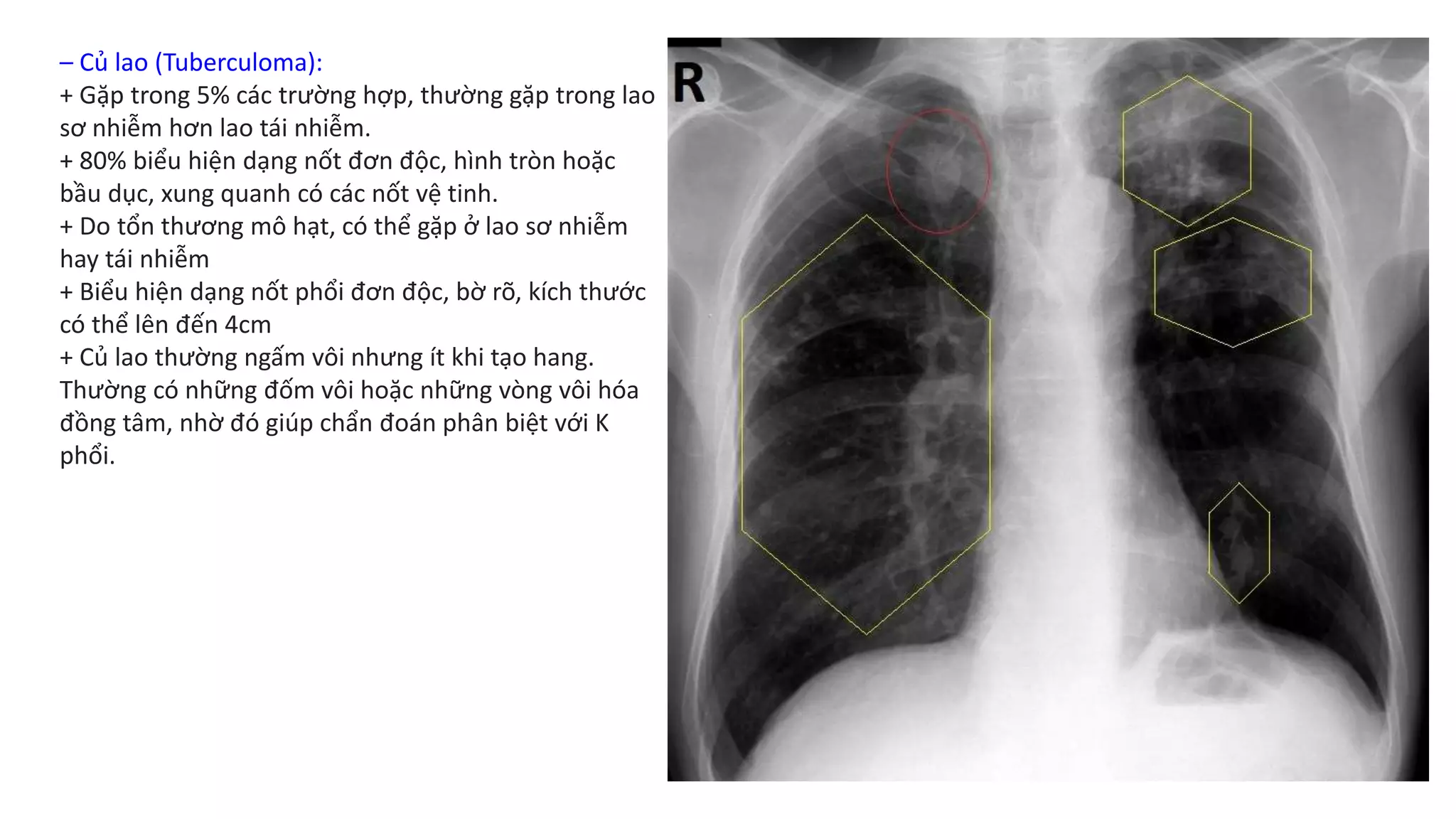 Chẩn Đoán Hình Ảnh Lao Phổi - X quang lao phổi | PPTX