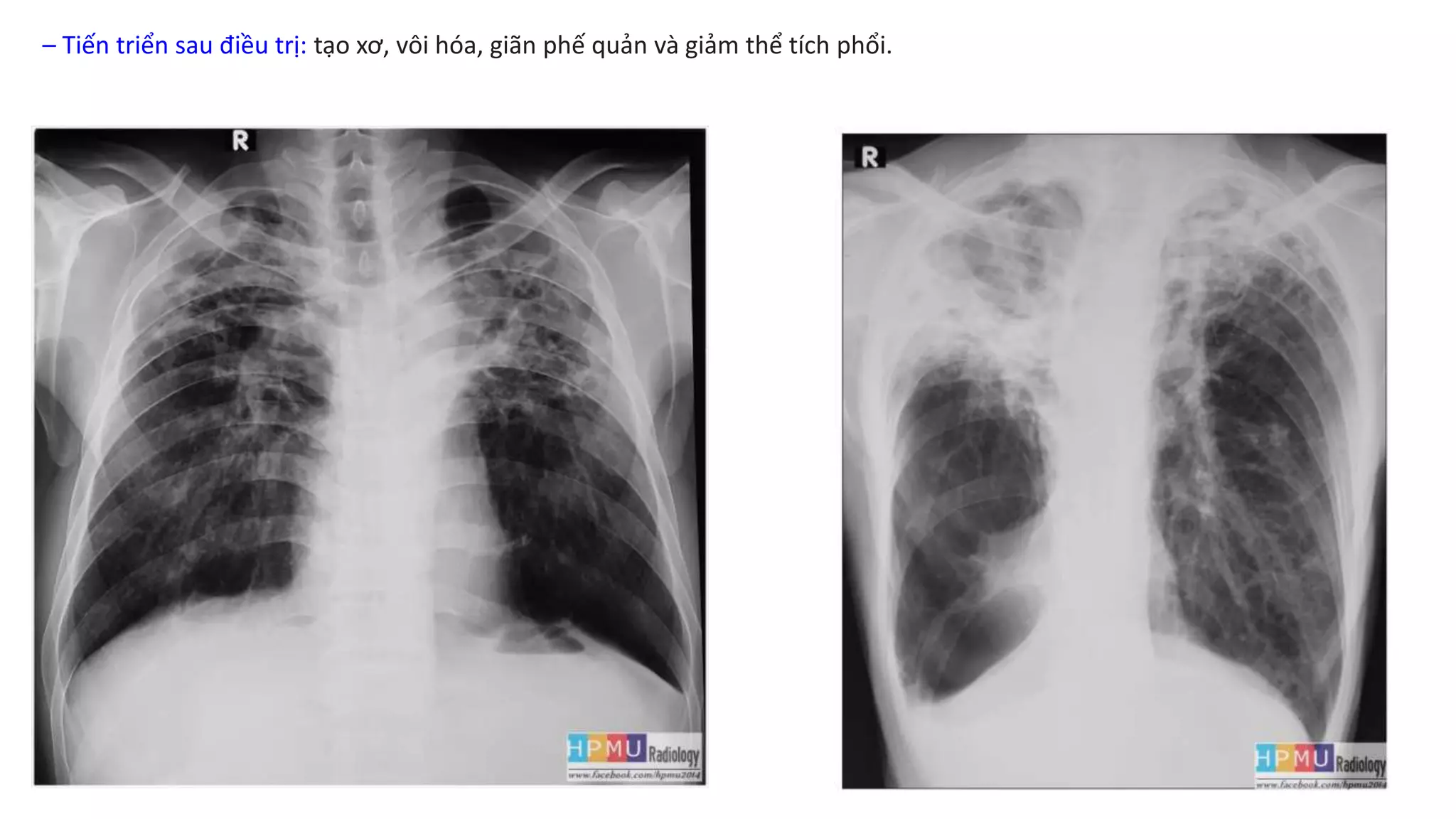 Chẩn Đoán Hình Ảnh Lao Phổi - X quang lao phổi | PPTX
