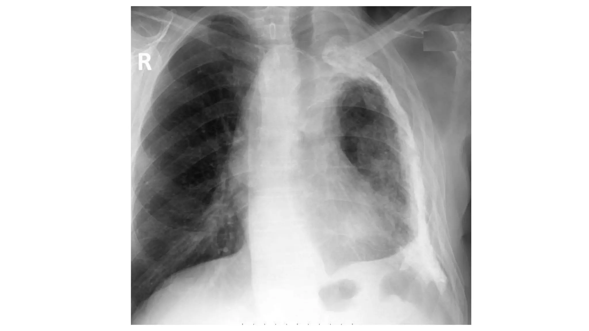 Chẩn Đoán Hình Ảnh Lao Phổi - X quang lao phổi | PPTX