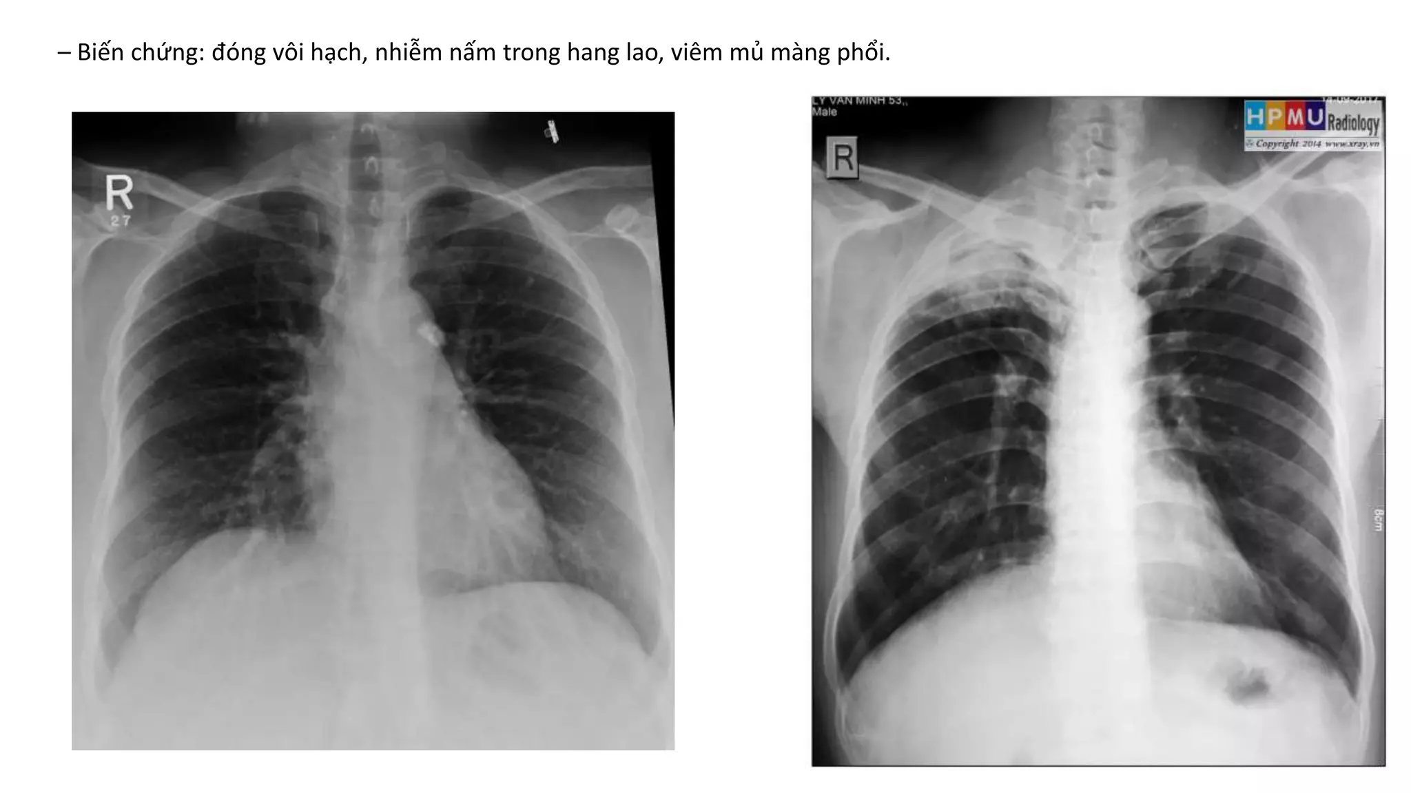 Chẩn Đoán Hình Ảnh Lao Phổi - X quang lao phổi | PPTX
