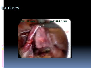 Lap anatomy and complications2012 | PDF