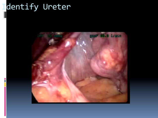 Lap anatomy and complications2012 | PPT