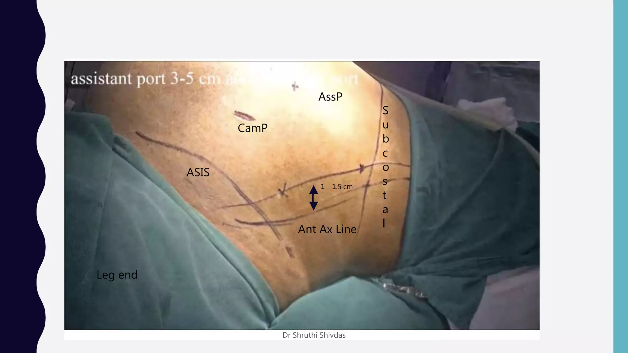 Basics of Laparoscopy Gyn | PPTX