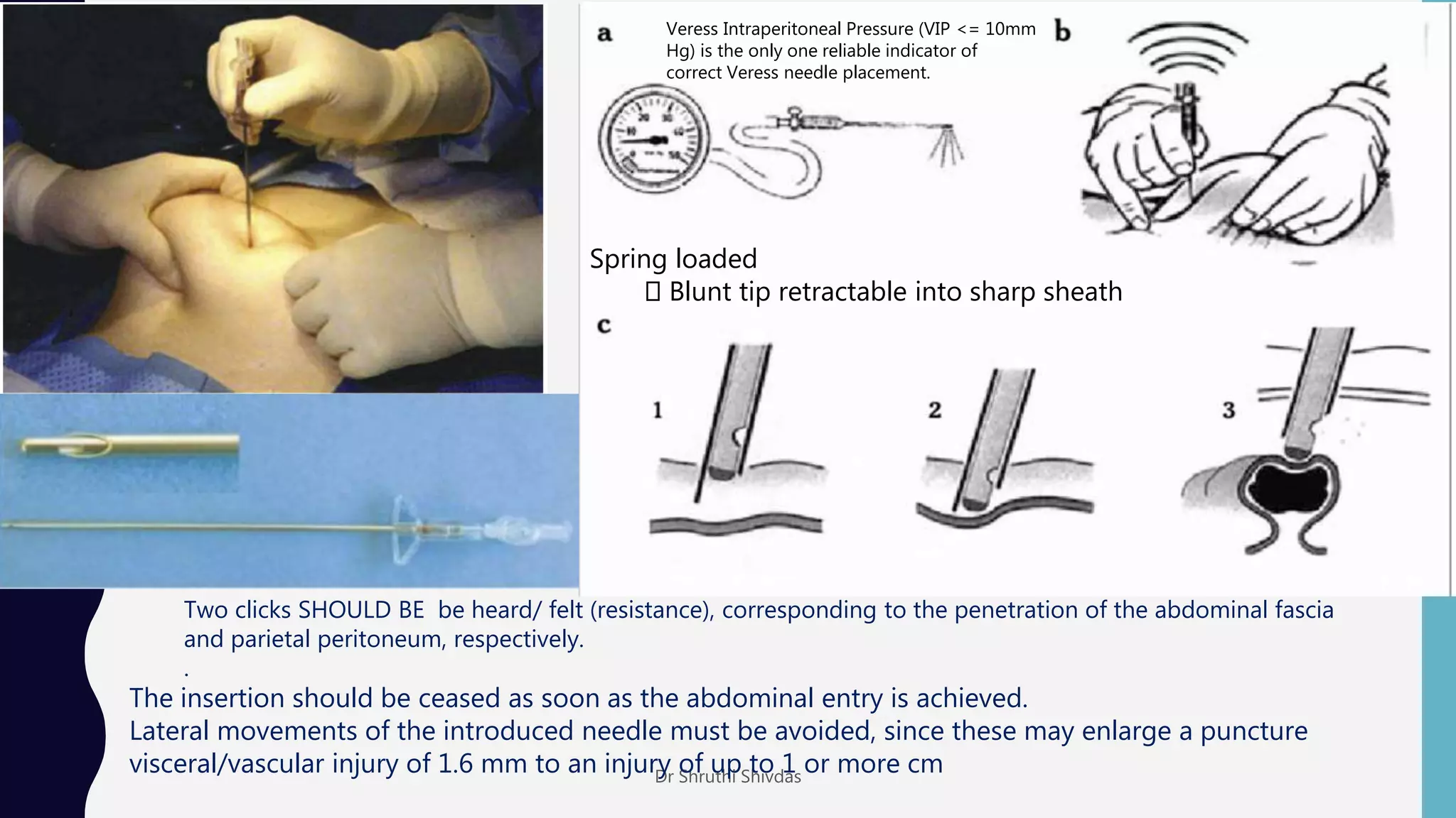 Basics of Laparoscopy Gyn | PPTX