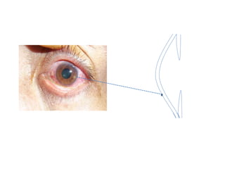 corpus alienum | PPTX