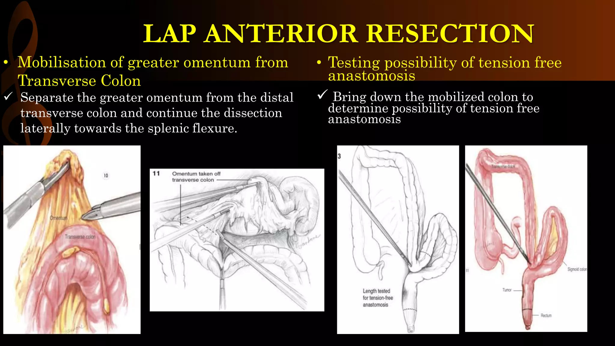LAP ANTERIOR RESECTION-STEP BY STEP Operative Surgery.pptx