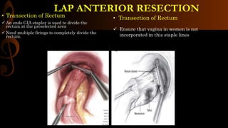 LAP ANTERIOR RESECTION-STEP BY STEP Operative Surgery.pptx