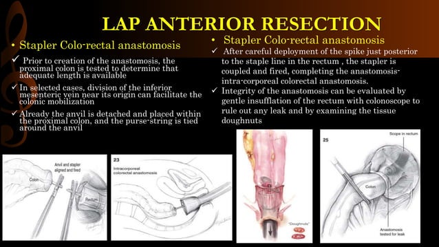 LAP ANTERIOR RESECTION-STEP BY STEP Operative Surgery.pptx