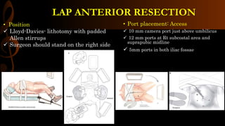 LAP ANTERIOR RESECTION-STEP BY STEP Operative Surgery.pptx