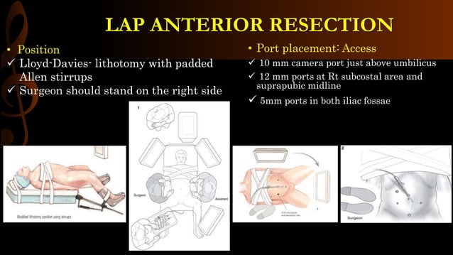LAP ANTERIOR RESECTION-STEP BY STEP Operative Surgery.pptx