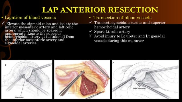 LAP ANTERIOR RESECTION-STEP BY STEP Operative Surgery.pptx