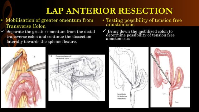 LAP ANTERIOR RESECTION-STEP BY STEP Operative Surgery.pptx