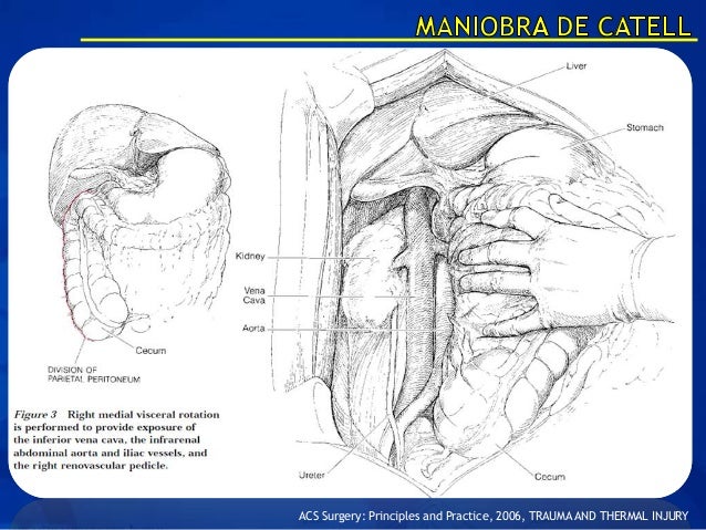 Laparatomia exploradora